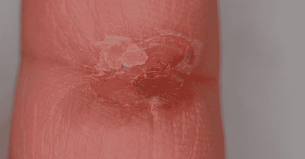 10 Signs Your Wound Might Be Infected and When to Seek Help - Bellagio ...