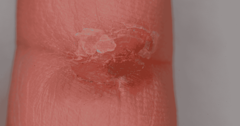 10 Signs Your Wound Might Be Infected and When to Seek Help - Bellagio ...