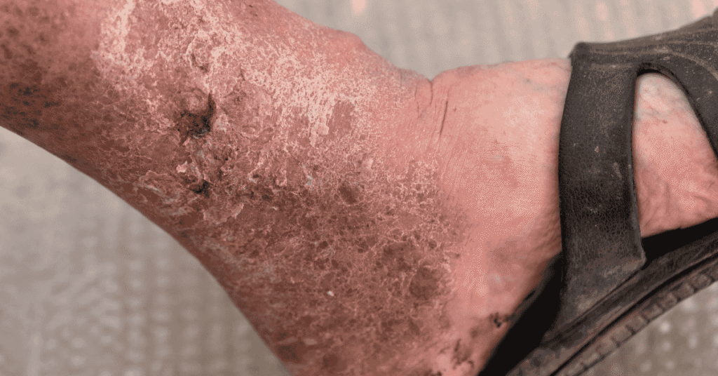 Venous Leg Ulcers: Causes, Symptoms, and Treatment - Bellagio Wound Care